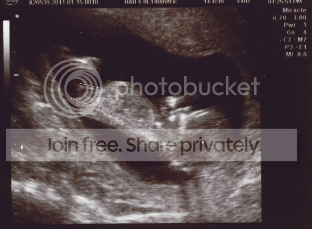 Looks like I might be getting my little girl!!! Nub U/S @ 13 weeks ...